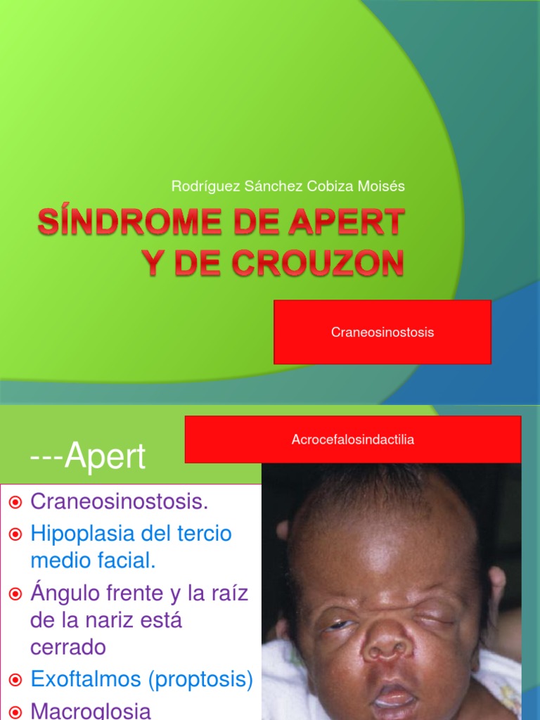 Síndrome de Apert y de Crouzon | PDF