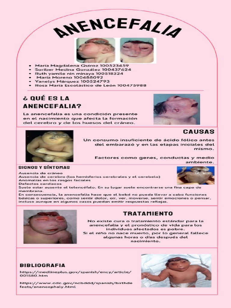 Anencefalia 2 | PDF