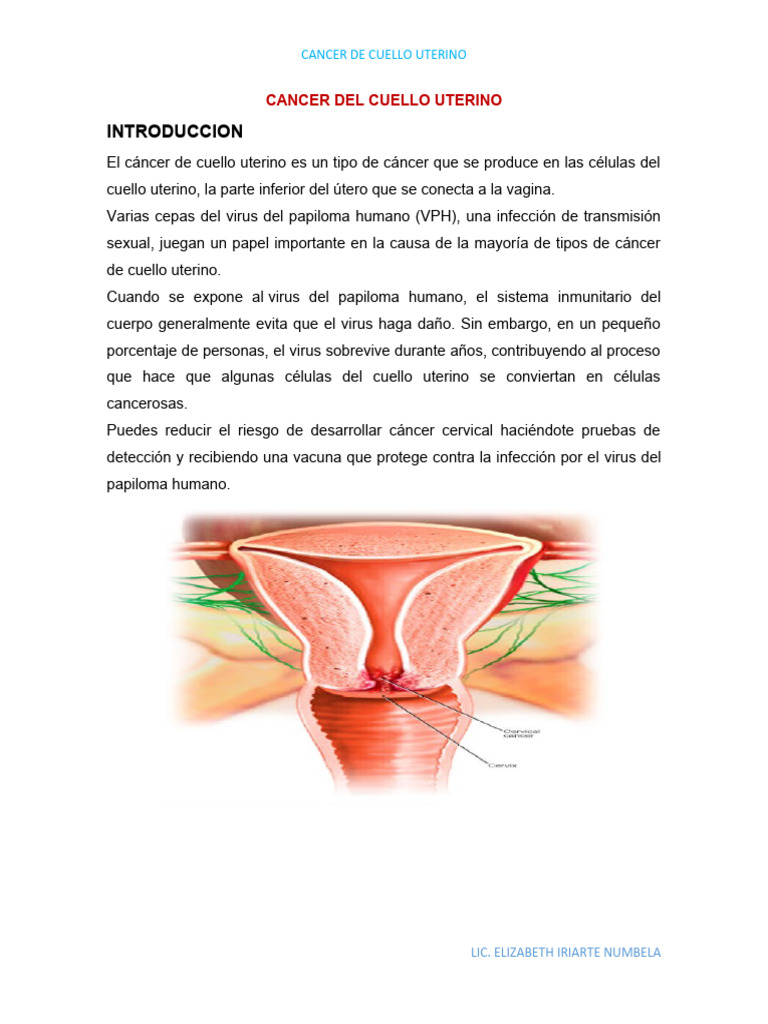 Cancer Del Cuello Uterino | PDF | Cáncer de cuello uterino | Cáncer