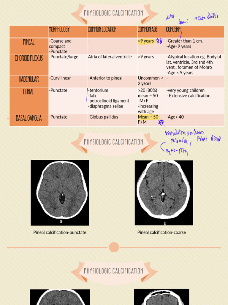 Pineal Choroid Plexus Habenular Dural: Physiologic Calcification | PDF ...
