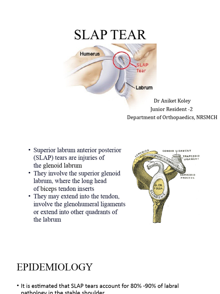 Slap Tear | PDF | Shoulder | Anatomical Terms Of Motion
