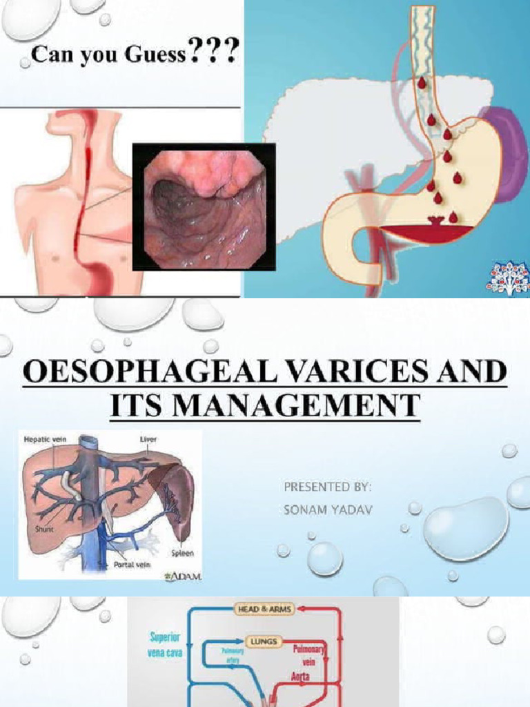 Oesophageal Varices PPT Slideshare | PDF