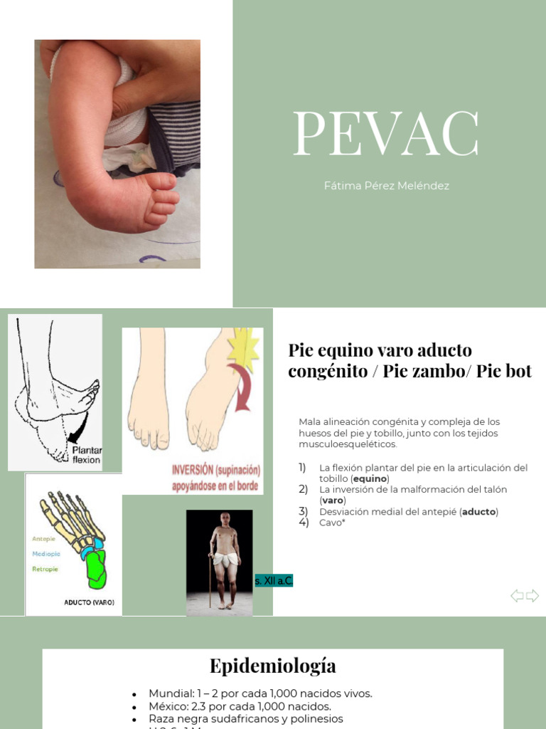 Pie Equino Varo Aducto Congénito | PDF