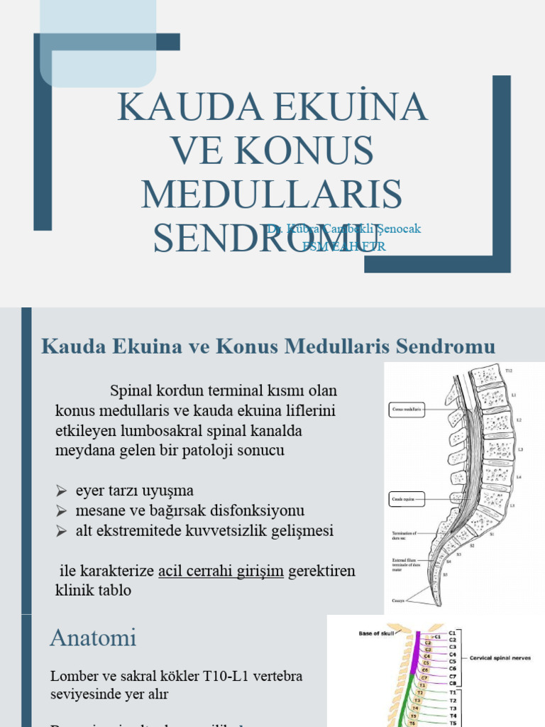 Kauda Ekuiì Na Ve Konus Medullariì S Sendromu | PDF