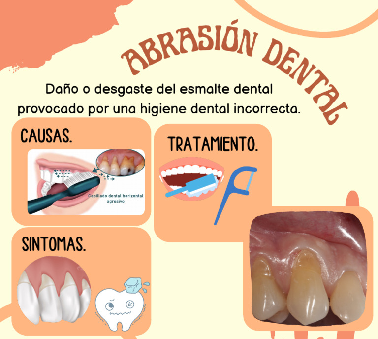 Causas y tratamiento de la abrasión dental | PDF