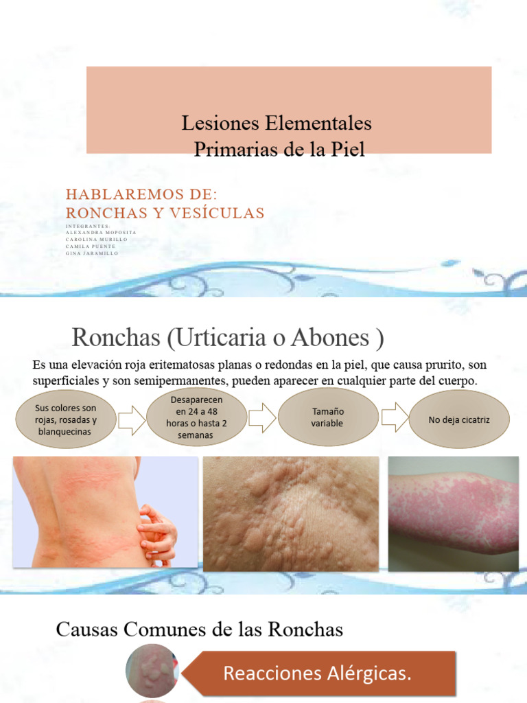 Ronchas y Vesículas: Causas y Características | PDF