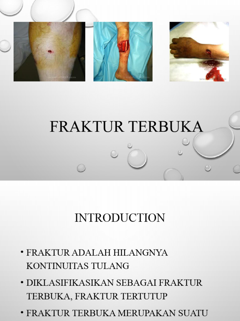 Fraktur Terbuka | PDF