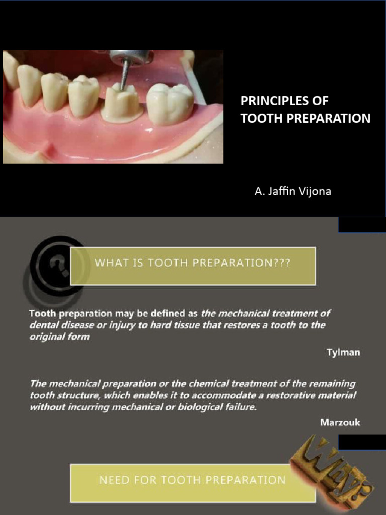 Principles of Tooth Preparation | PDF