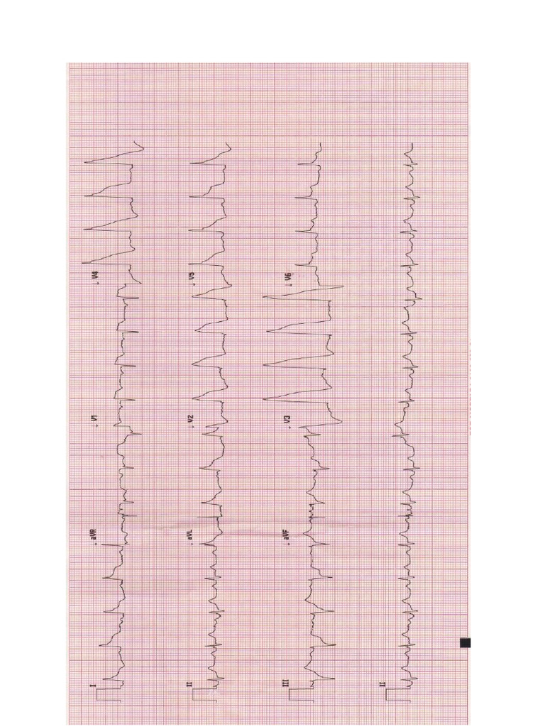 Ecg 1 | PDF