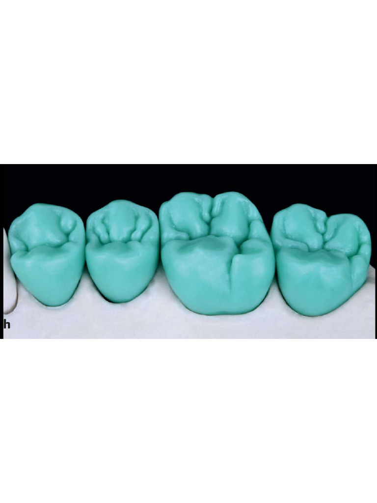 Upper Posterior | PDF