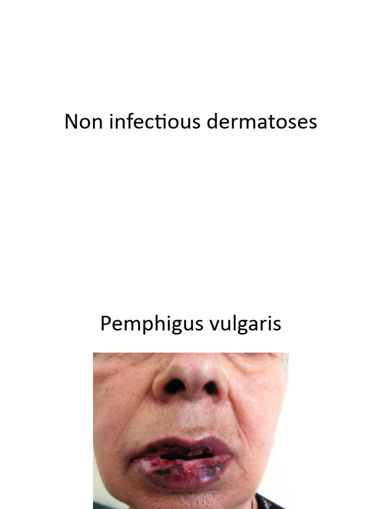 Dermatitis Seborrhoica Overview | PDF