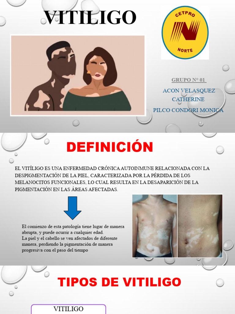 VITILIGO | PDF | Especialidades Medicas | Medicina