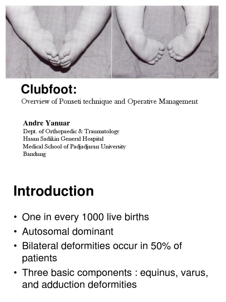 Clubfoot | Foot | Musculoskeletal System
