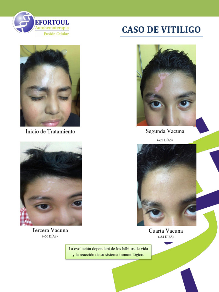 Caso de Vitiligo_Evidencia Fotográfica | PDF