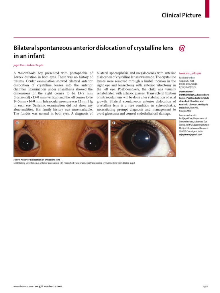 Bilateral Spontaneous Anterior Dislocation of Crystalline Lens | PDF
