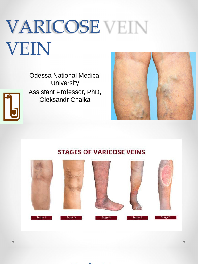 +oleksandr Chaika Theme 15 Varicose Veins. | PDF | Vein | Causes Of Death