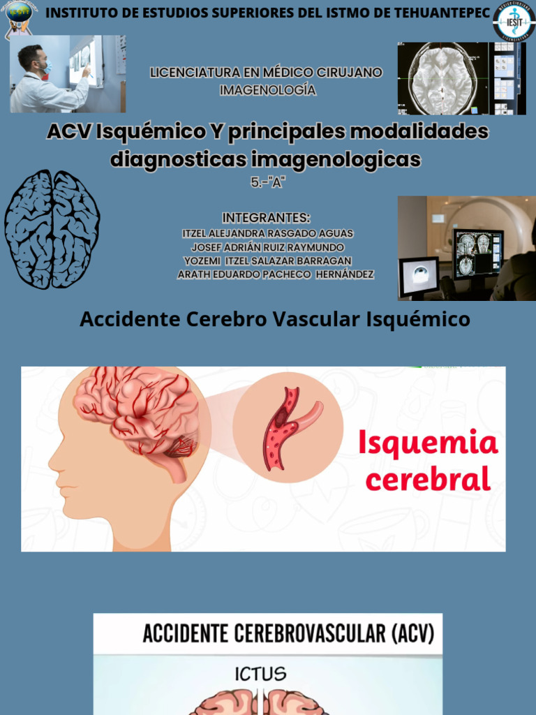 Acv Isquemico | PDF | Angiografía | Isquemia