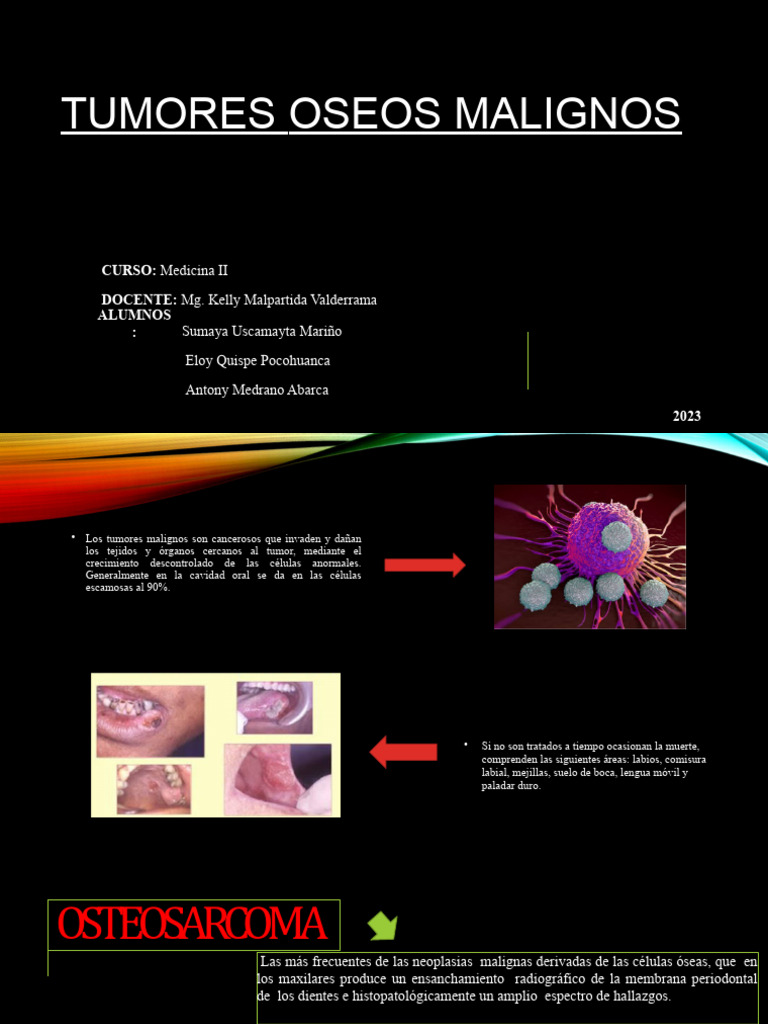 Tumores Oseos Malignos 15 | PDF