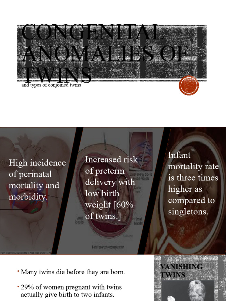 Congenital Anomalies of Twins | PDF | Twin | Conjoined Twins