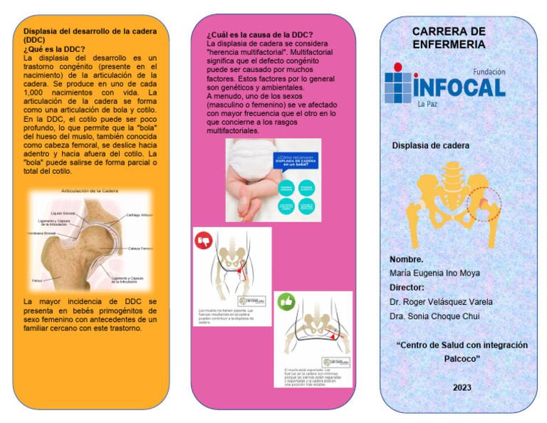 Displasia de Cadera B | PDF