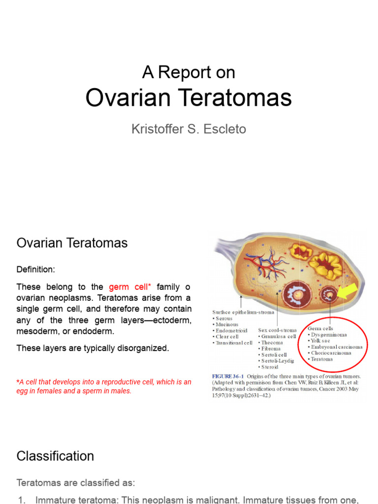 Teratomas | PDF | Ovarian Cancer | Neoplasms
