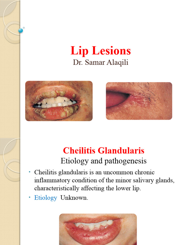 Lip Lesion | PDF | Causes Of Death | Digestive Diseases