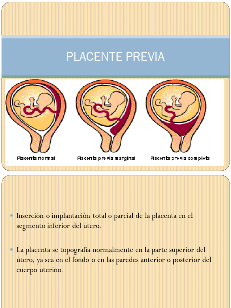 Placenta Previa | Descargar gratis PDF | Placenta | Parto