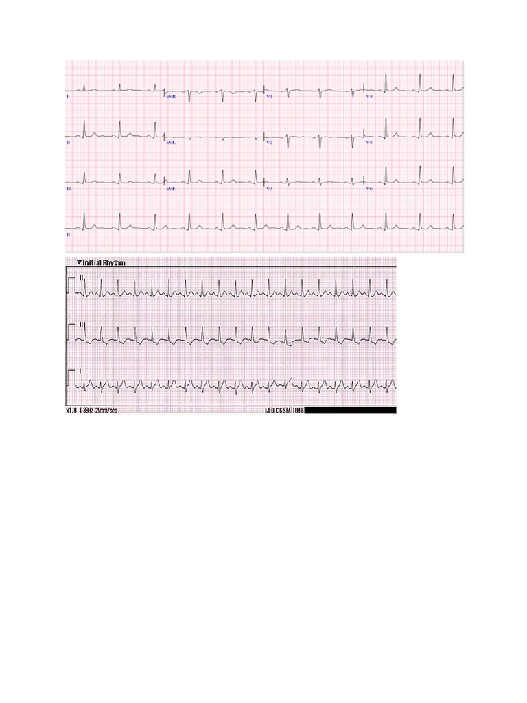 Tarea EKG | PDF