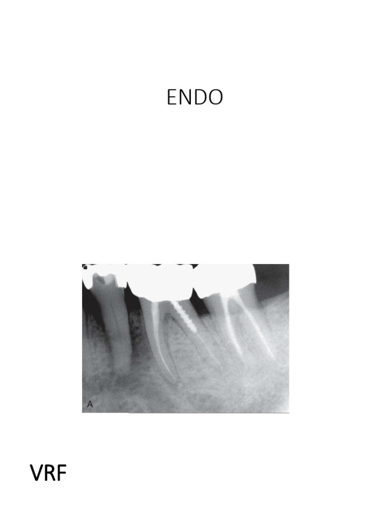 ENDO Question | PDF