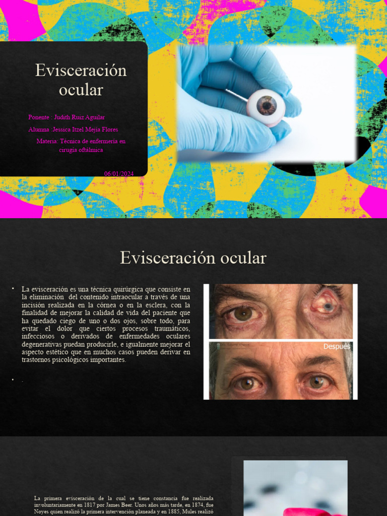 Evisceración Ocular | PDF | Dentadura postiza | Ojo humano