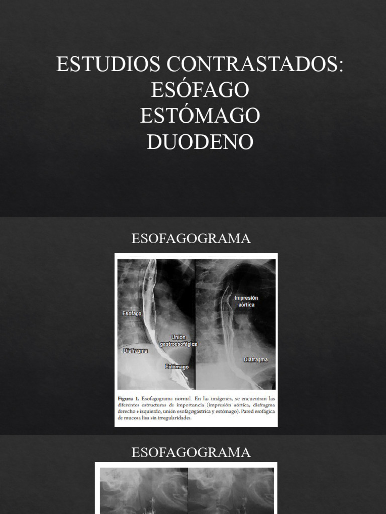 Contrastado Esofago Estomago Duodeno | PDF