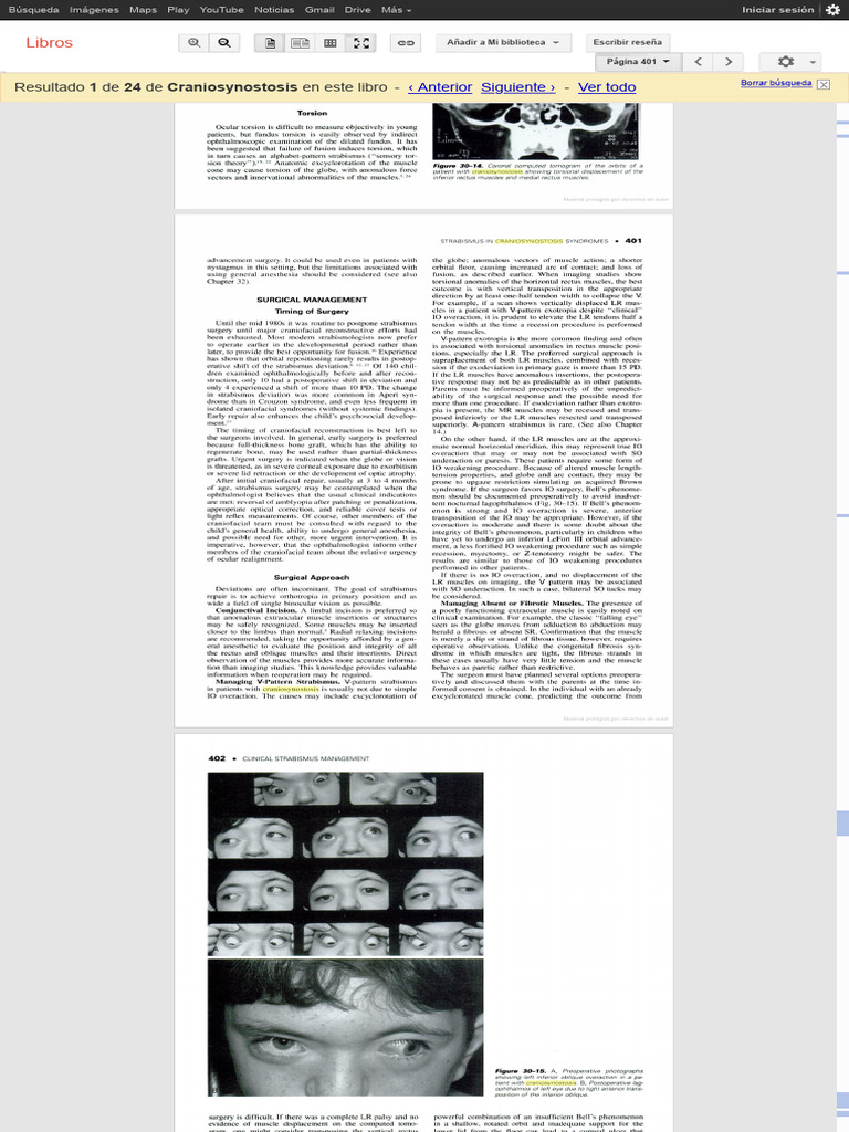 Clinical Strabismus Management Principles and Su | PDF