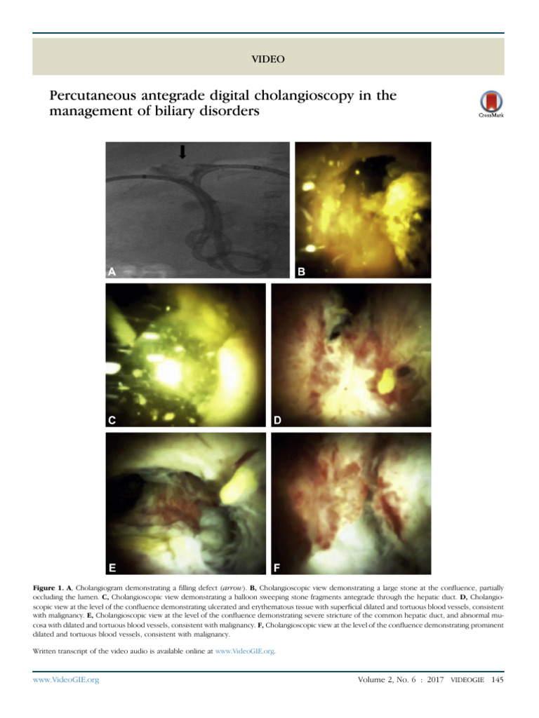 Percutaneous Antegrade Digital Cholangioscopy in T | PDF | Medical ...