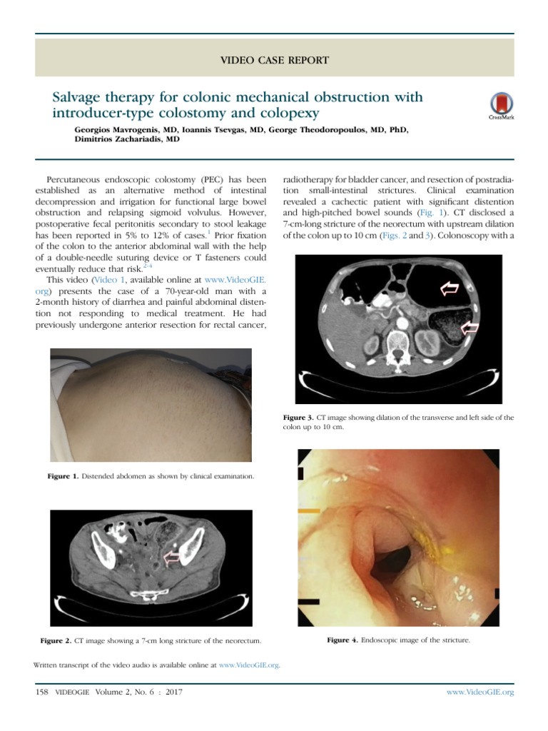 Salvage Therapy For Colonic Mechanical Obstruction | PDF | Colorectal ...
