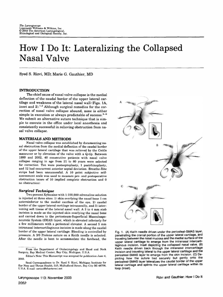 Lateralizing Collapsed Nasal Valve Technique | PDF | Human Nose | Surgery