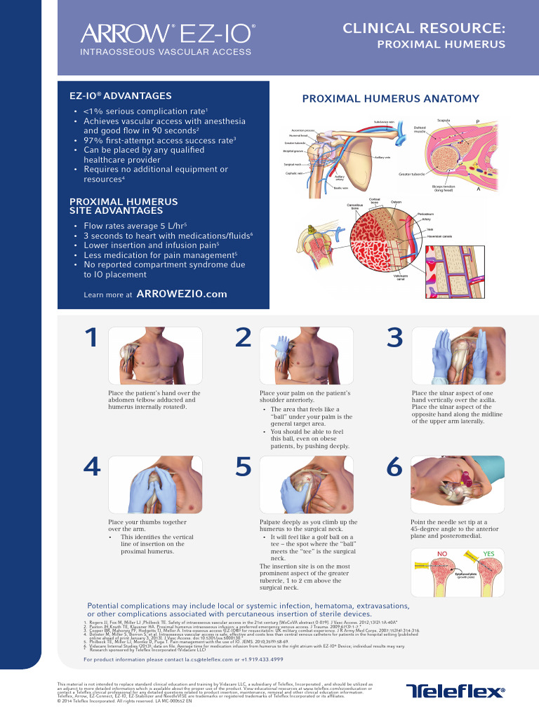 EZ-IO Proximal Humerus Poster PDF | PDF | Clinical Medicine ... EZ-IO Proximal Humerus Poster PDF | PDF | Clinical Medicine ...