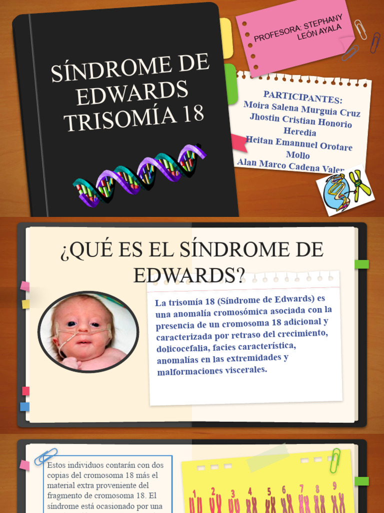 Características del Síndrome de Edwards | PDF | Trastorno genético ...