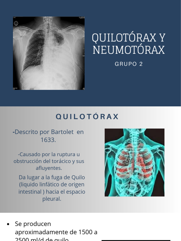 Tema 2 - Quilotorax Y Neumotorax | PDF | Enfermedades y trastornos ...