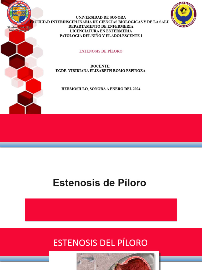 Estenosis de Píloro | PDF