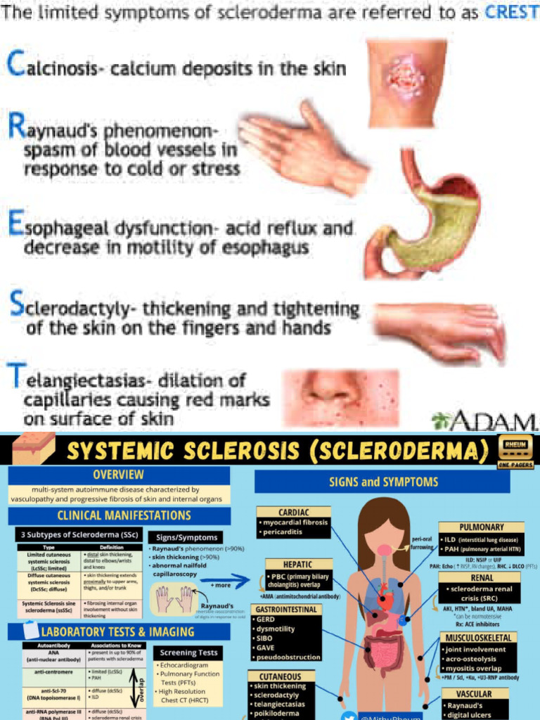 Systemic Sclerosis | PDF