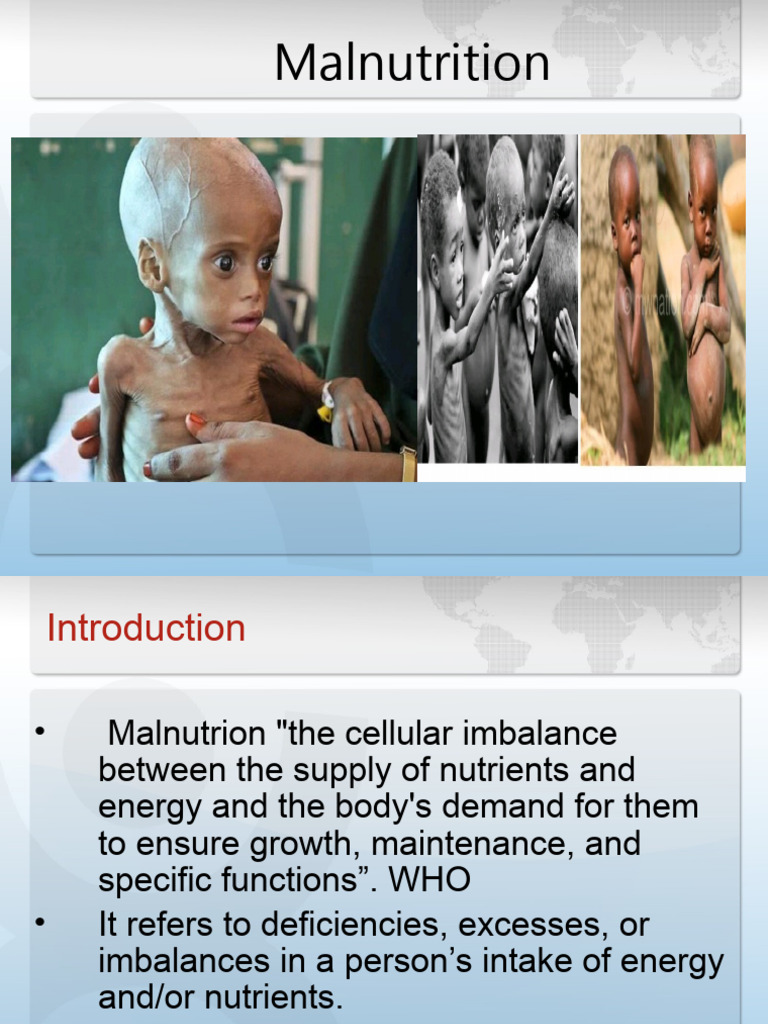 Malnutrition | PDF