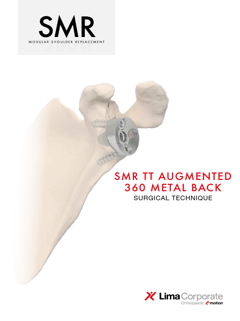 Lima - SMR TT Augmented 360 Metal Back - en | PDF | Shoulder | Musculoskeletal System
