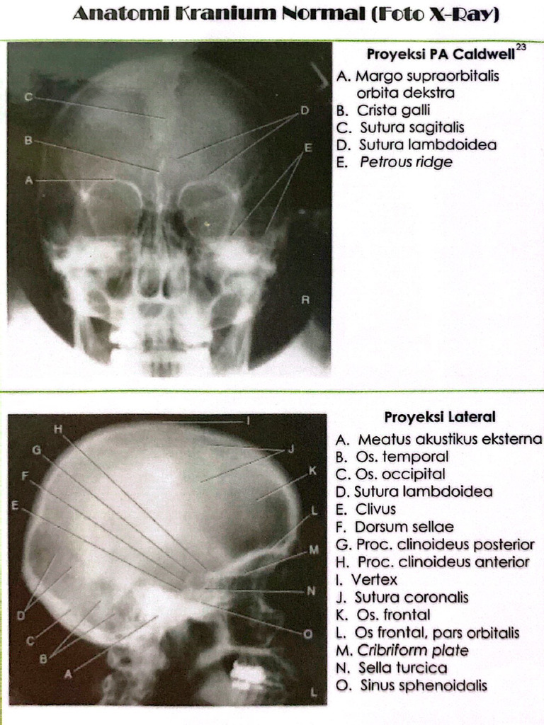 Radioanatomi Cranium | PDF