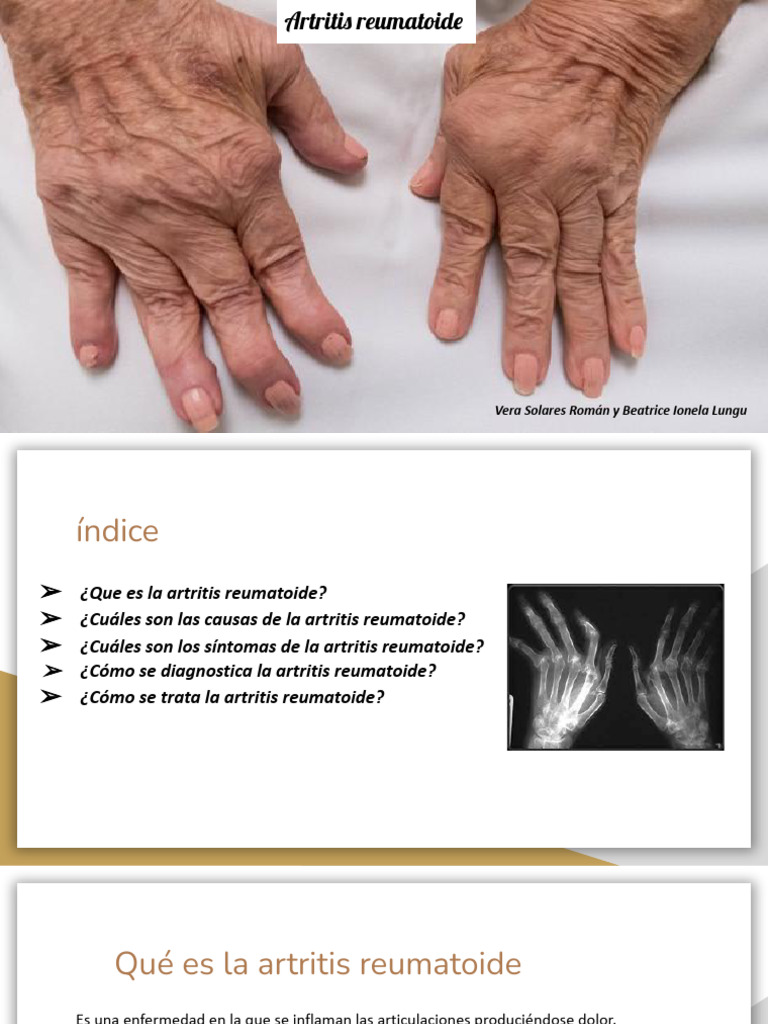 Artritis Reumatoide | PDF | Artritis | Artritis Reumatoide