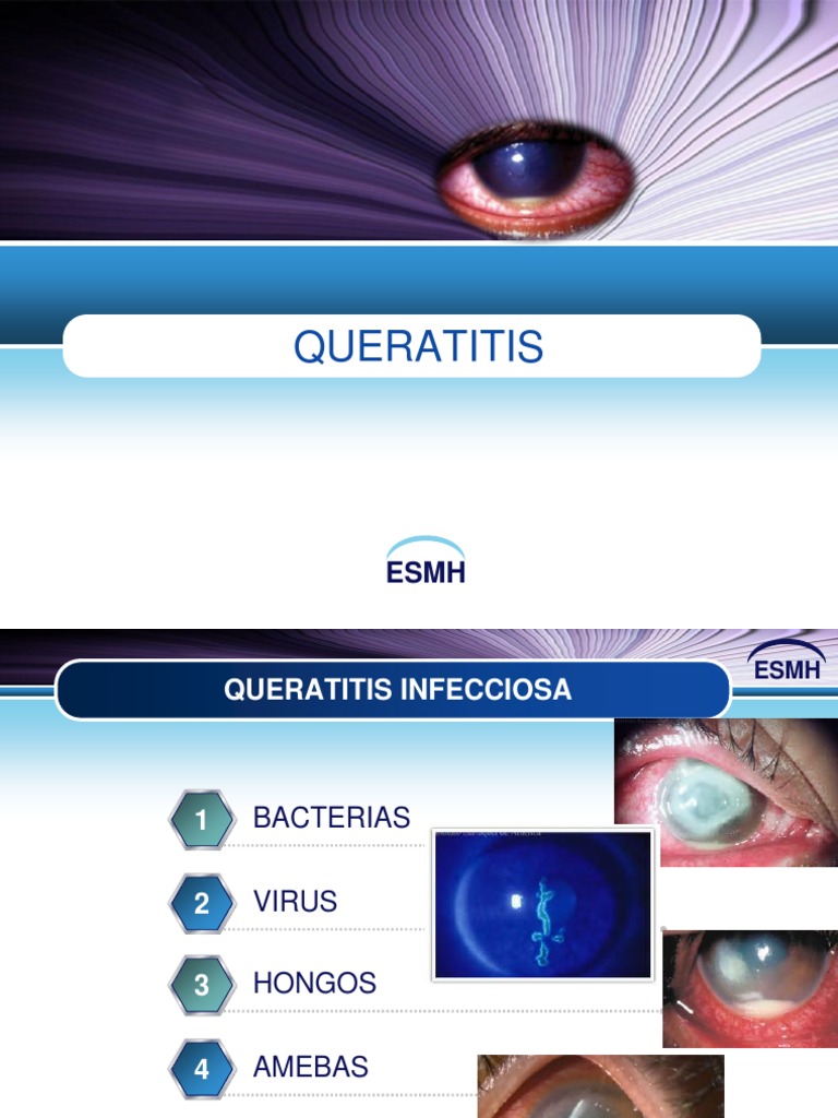 QUERATITIS infecciosa parte 1 | Enfermedades y trastornos | Oftalmología