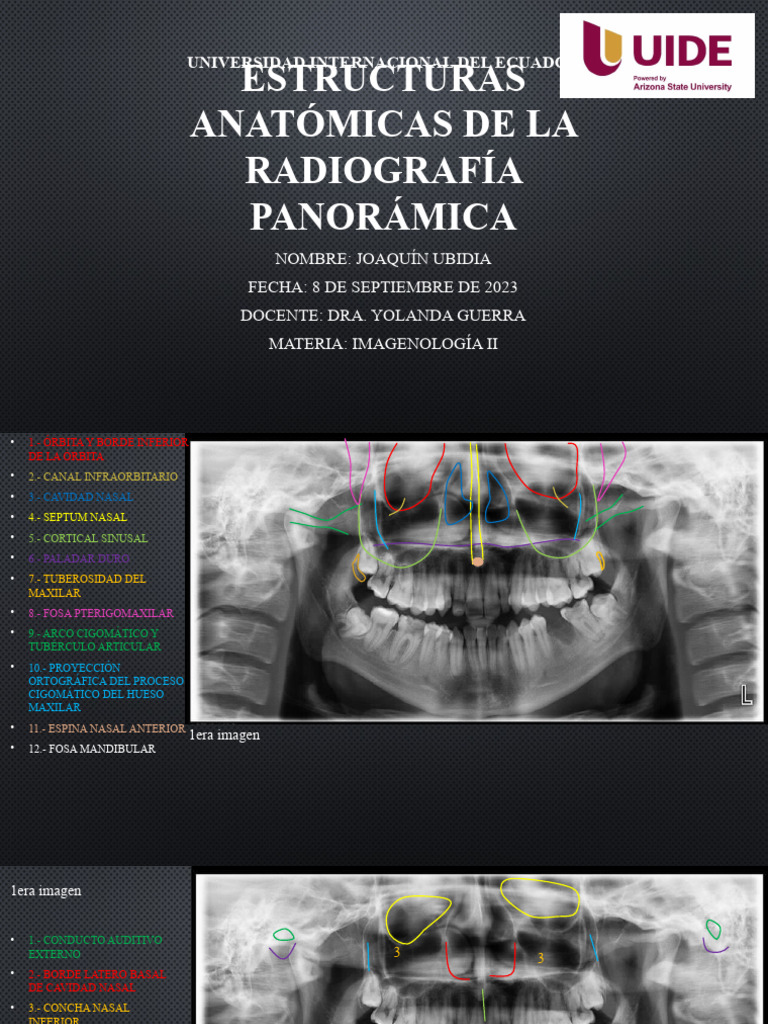 Estructuras Anatómicas de La Radiografía Panorámica | Descargar gratis PDF | Sistema ...