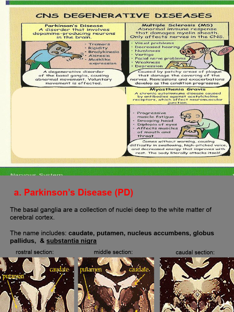 Degen Dses PDMSMG | PDF | Multiple Sclerosis | Parkinson's Disease