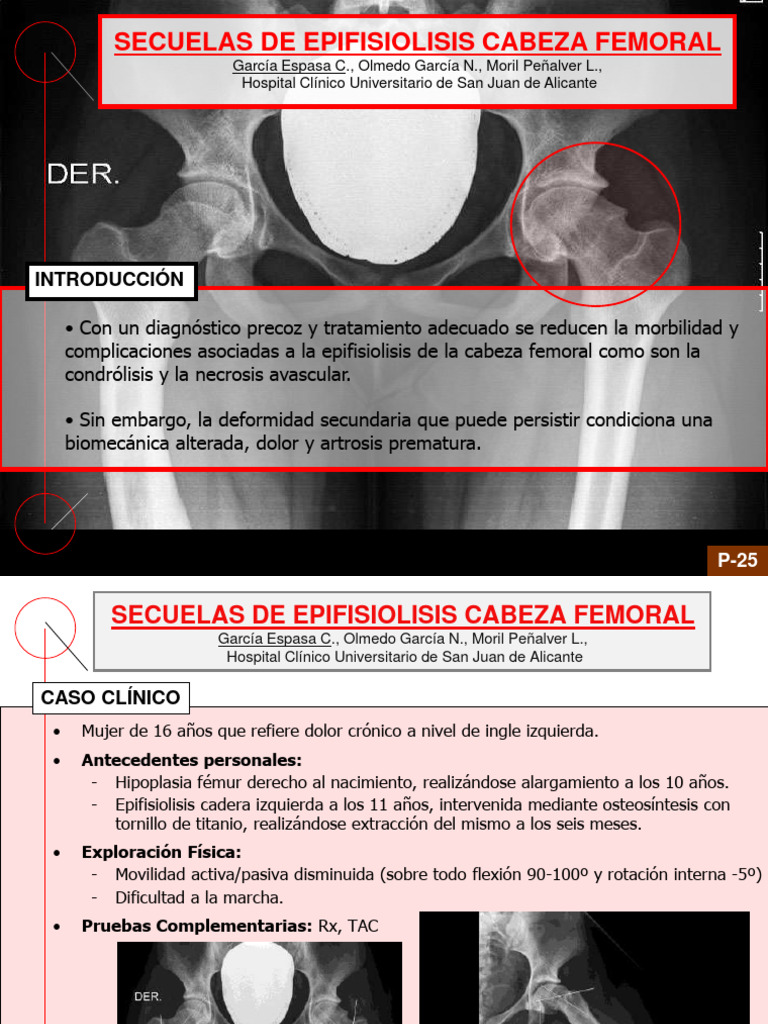 P-025 - Secuelas de Epifisiolisis Cabeza Femoral | PDF | Medicina ...