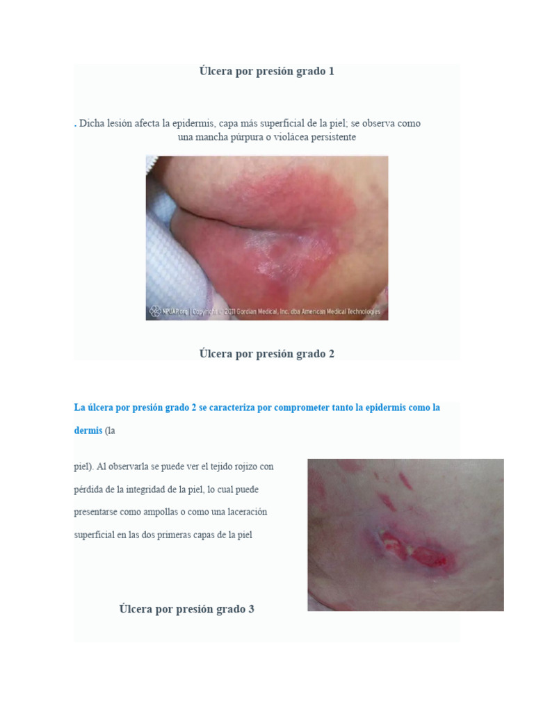 Úlcera Por Presión Grado 1 | PDF