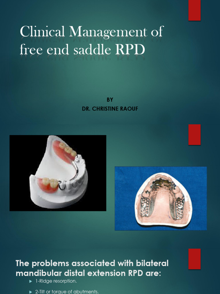 Clinical Management of Free End Saddle RPD Part I | PDF